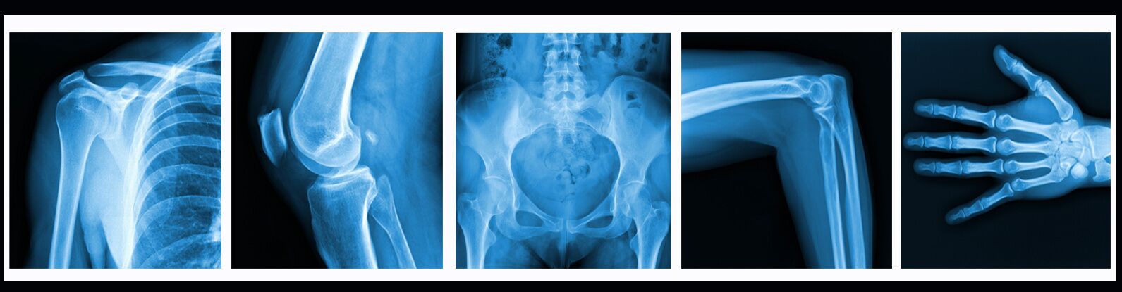 disc herniation x ray